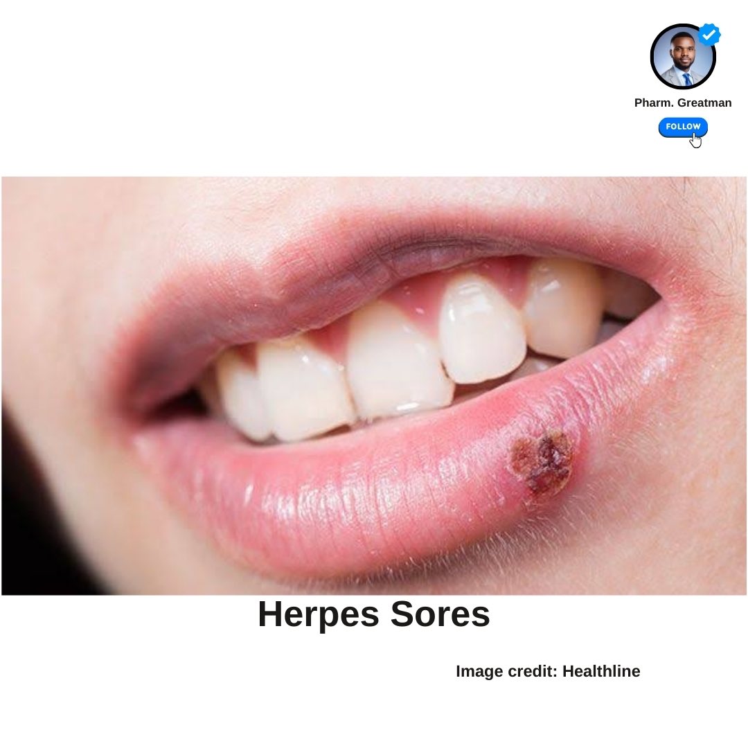 MOUTH BLISTERS Are blisters near the mouth always herpes? For education ...