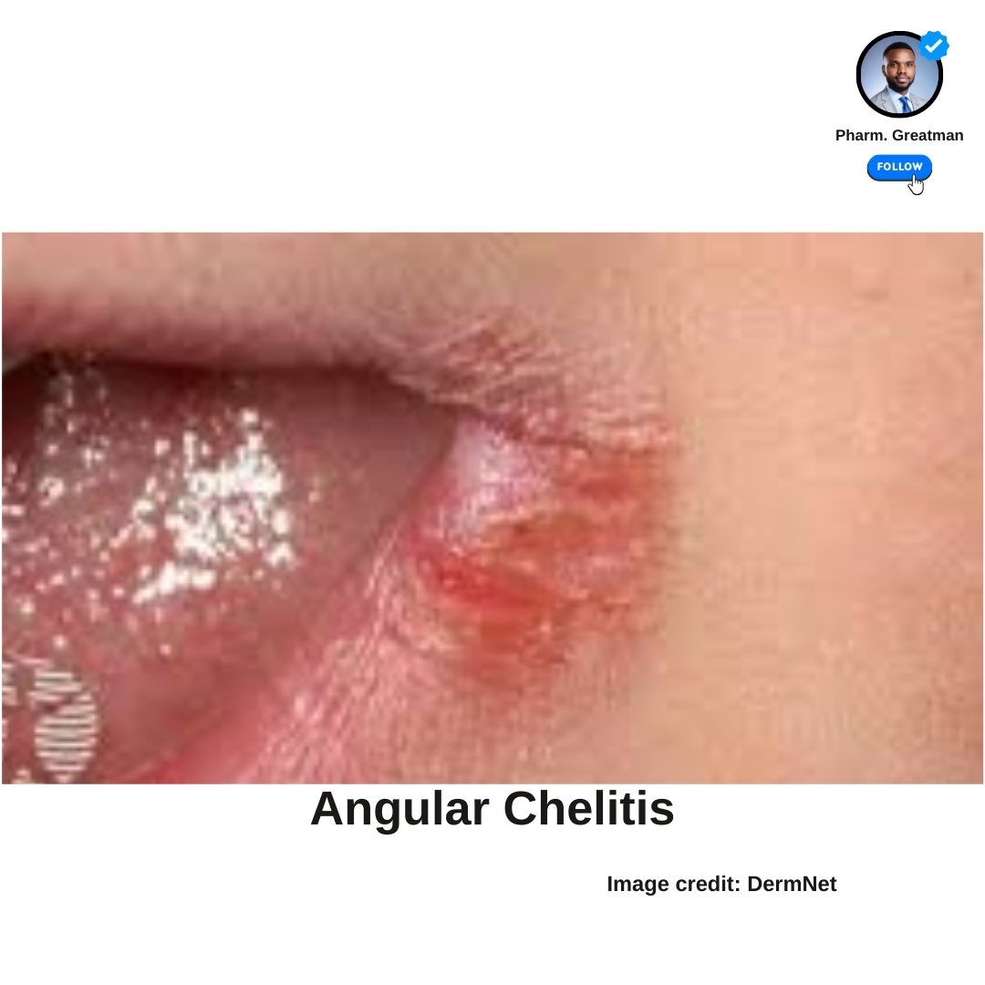 MOUTH BLISTERS Are blisters near the mouth always herpes? For education purposes, this thread ...