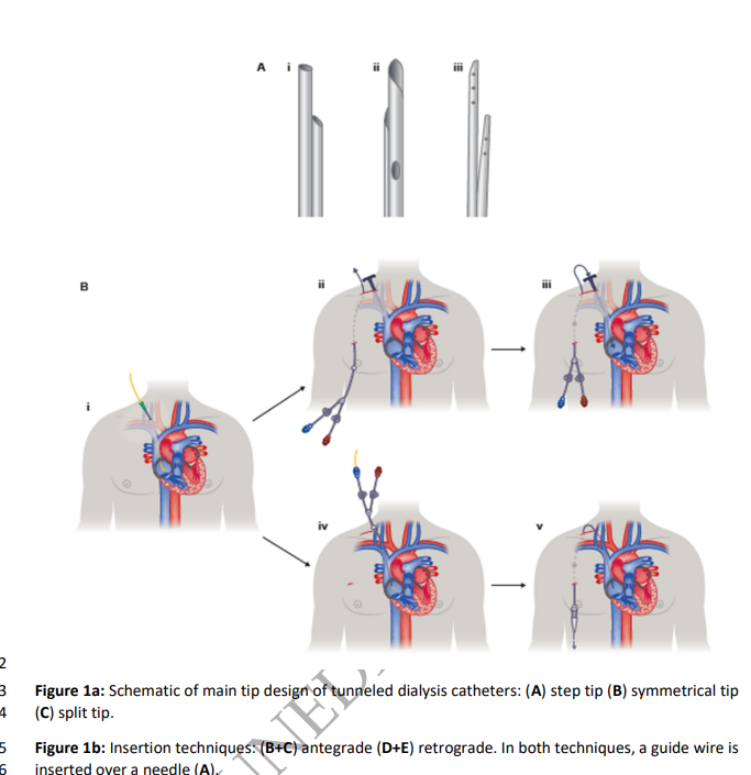 Tunneled Hemodialysis Catheter Placement Dialysis Line Insertion