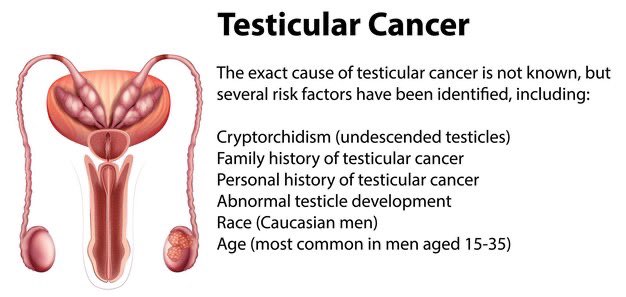 TESTICULAR CANCER 101 Testicular cancer is arguably the most common ...