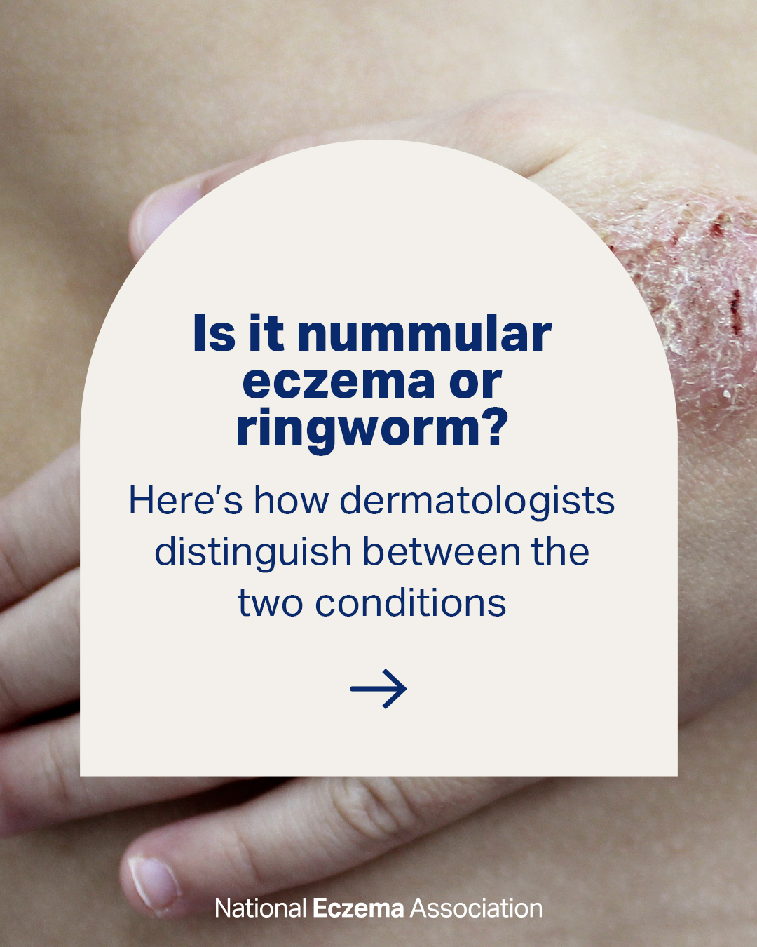 Eczema Nummular Eczema Vs Ringworm Pictures