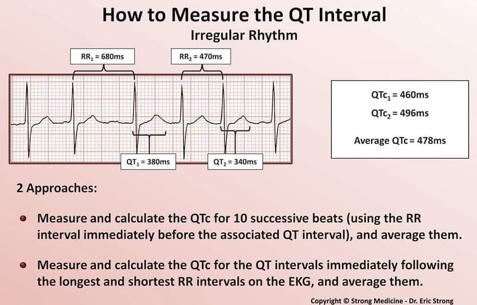 🔴 How to Measure QT Interval & Calculate the QTc Copyright @Strong ...