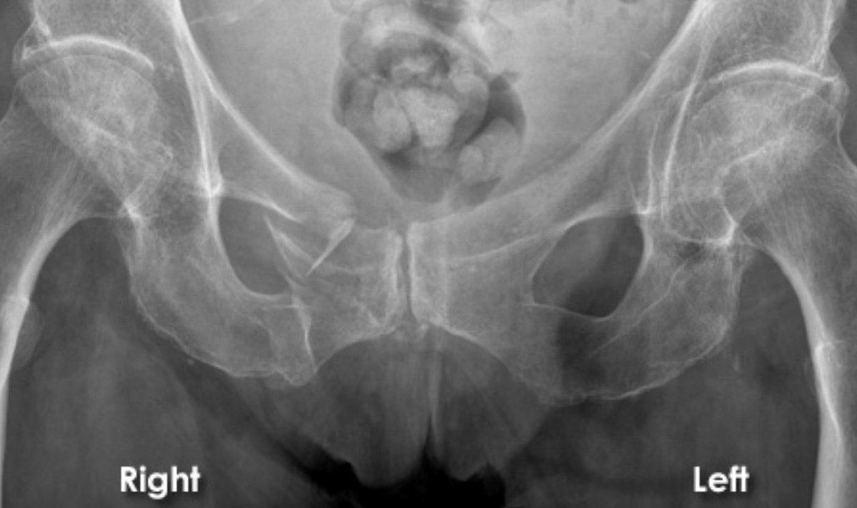 Pelvis anatomy - Normal AP Credits : Radiologymasterclass - Thread from ...