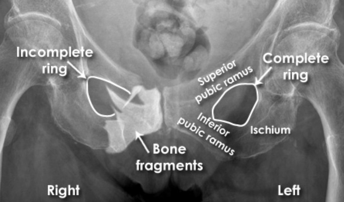 Pelvis anatomy - Normal AP Credits : Radiologymasterclass - Thread from ...