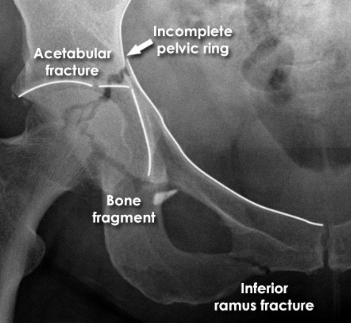 Pelvis Anatomy Normal Ap Credits Radiologymasterclass Thread From Daily Dose Of Medicine