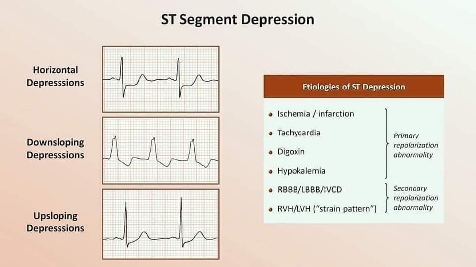 🔴 ST Segment Depression 1) ST depression can be either upsloping ...