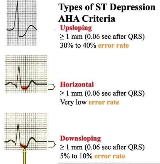 🔴 ST Segment Depression 1) ST depression can be either upsloping ...