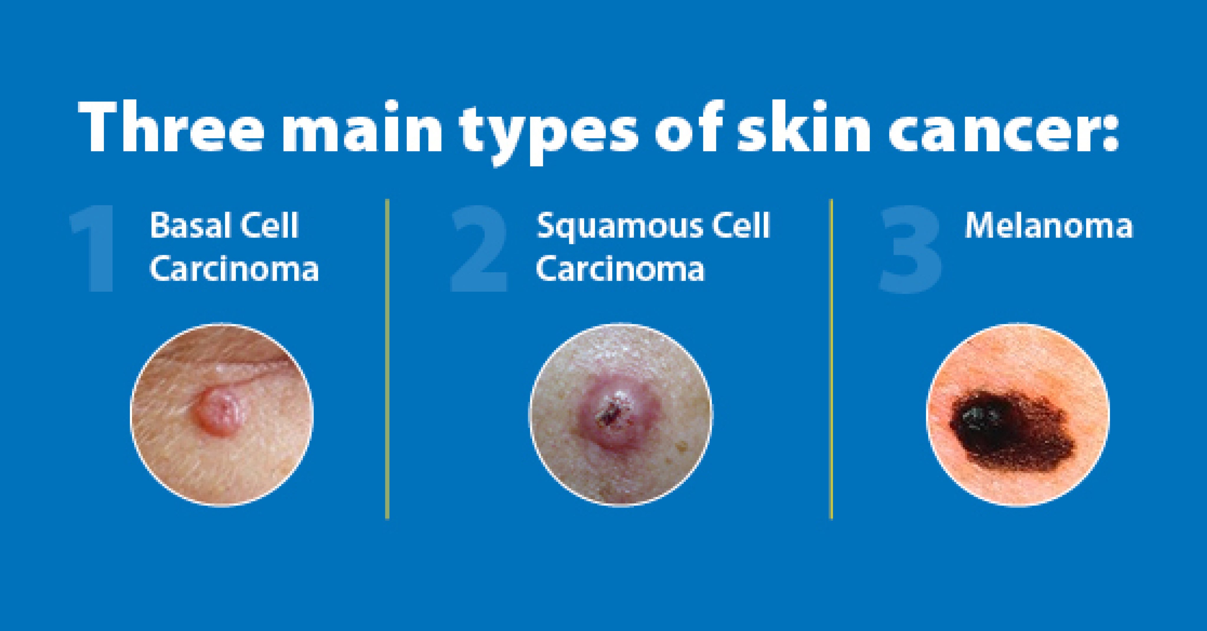 3 Types Of Skin Cancer Cells The 3 Main Types Of Skin Cancer | Blog