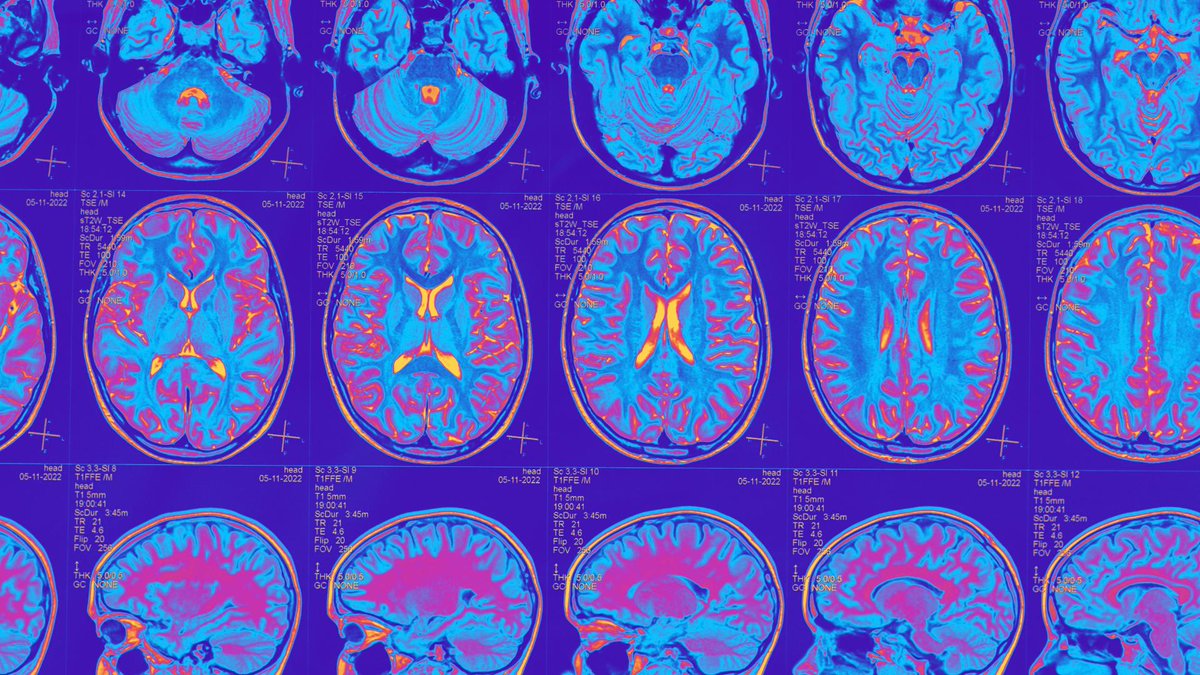 Thread by @BrainInflCollab on Thread Reader App – Thread Reader App