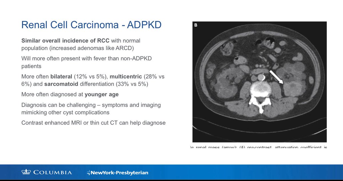 Summary of Autosomal dominant polycystic kidney disease (ADPKD) part1 # ...