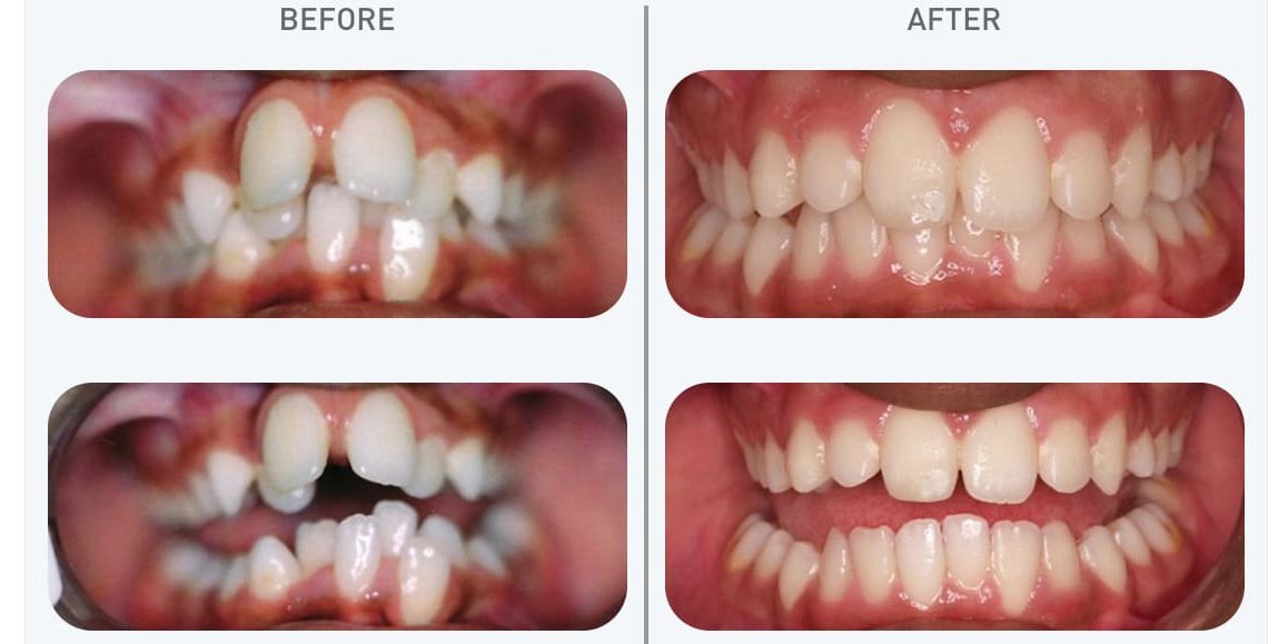 80% of children now have crooked teeth. Here is how to get straight ...