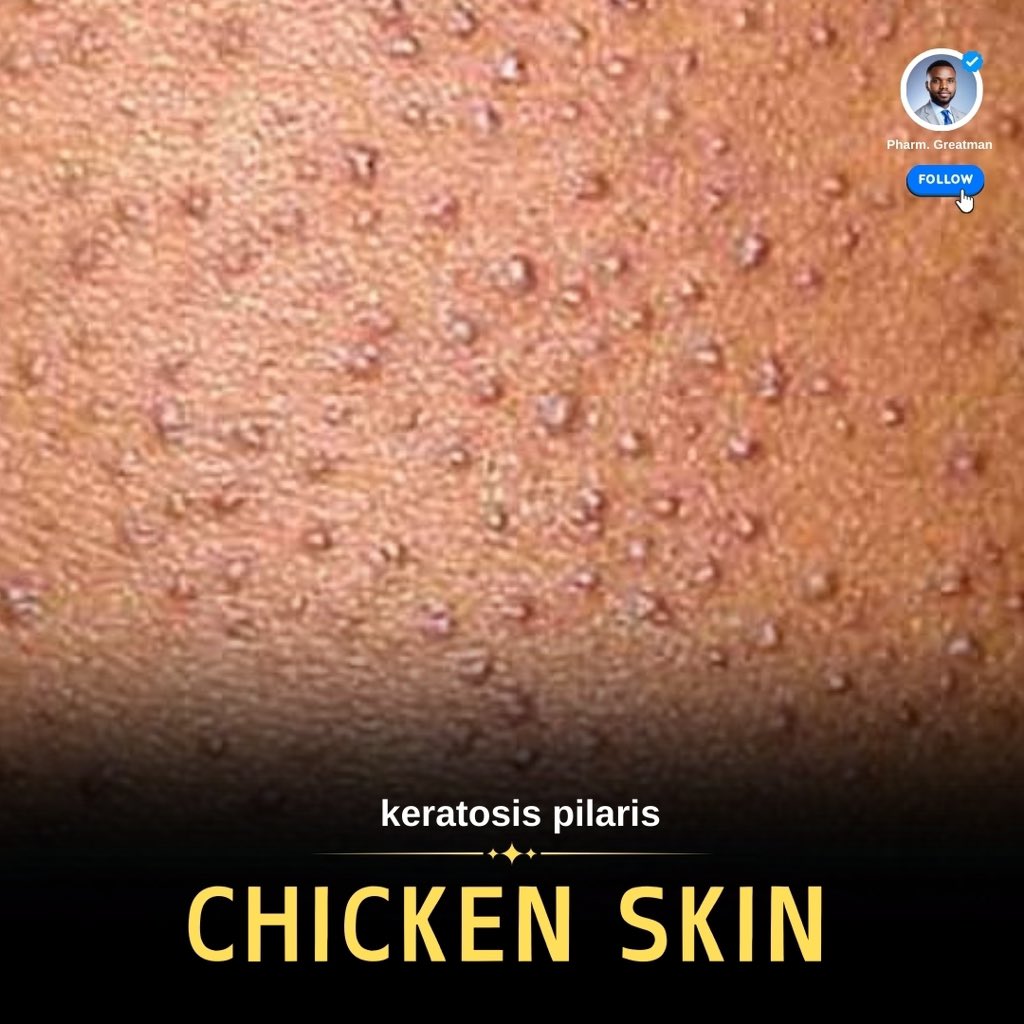 CHICKEN SKIN Have you noticed tiny, rough bumps on your skin that feel ...