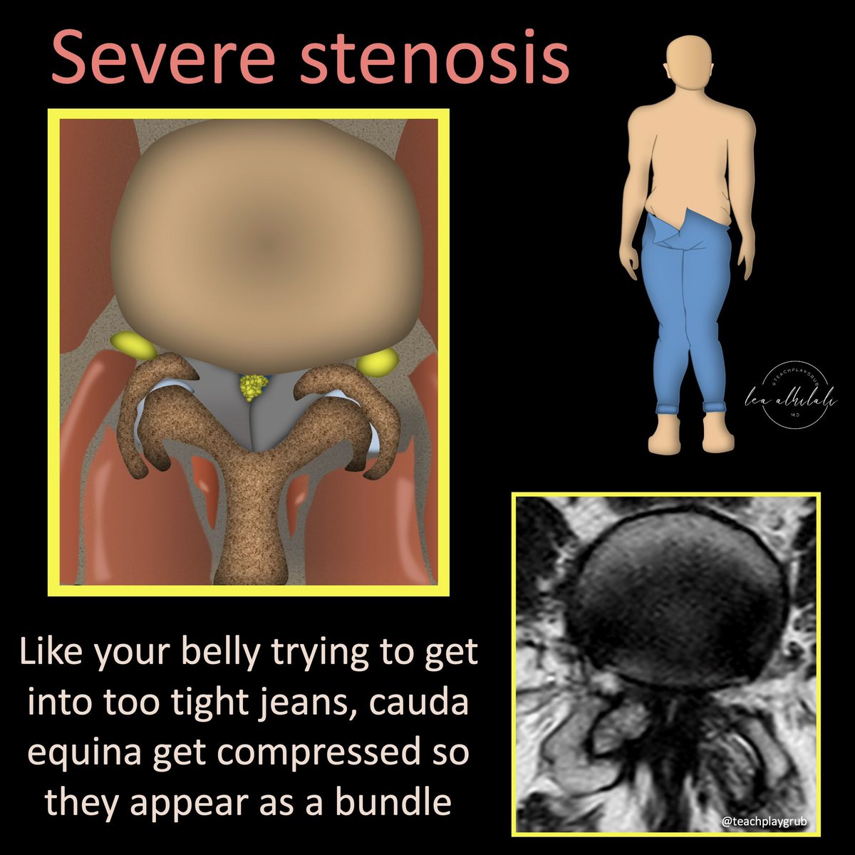 1/Hate it when one radiologist called the stenosis mild, the next one ...
