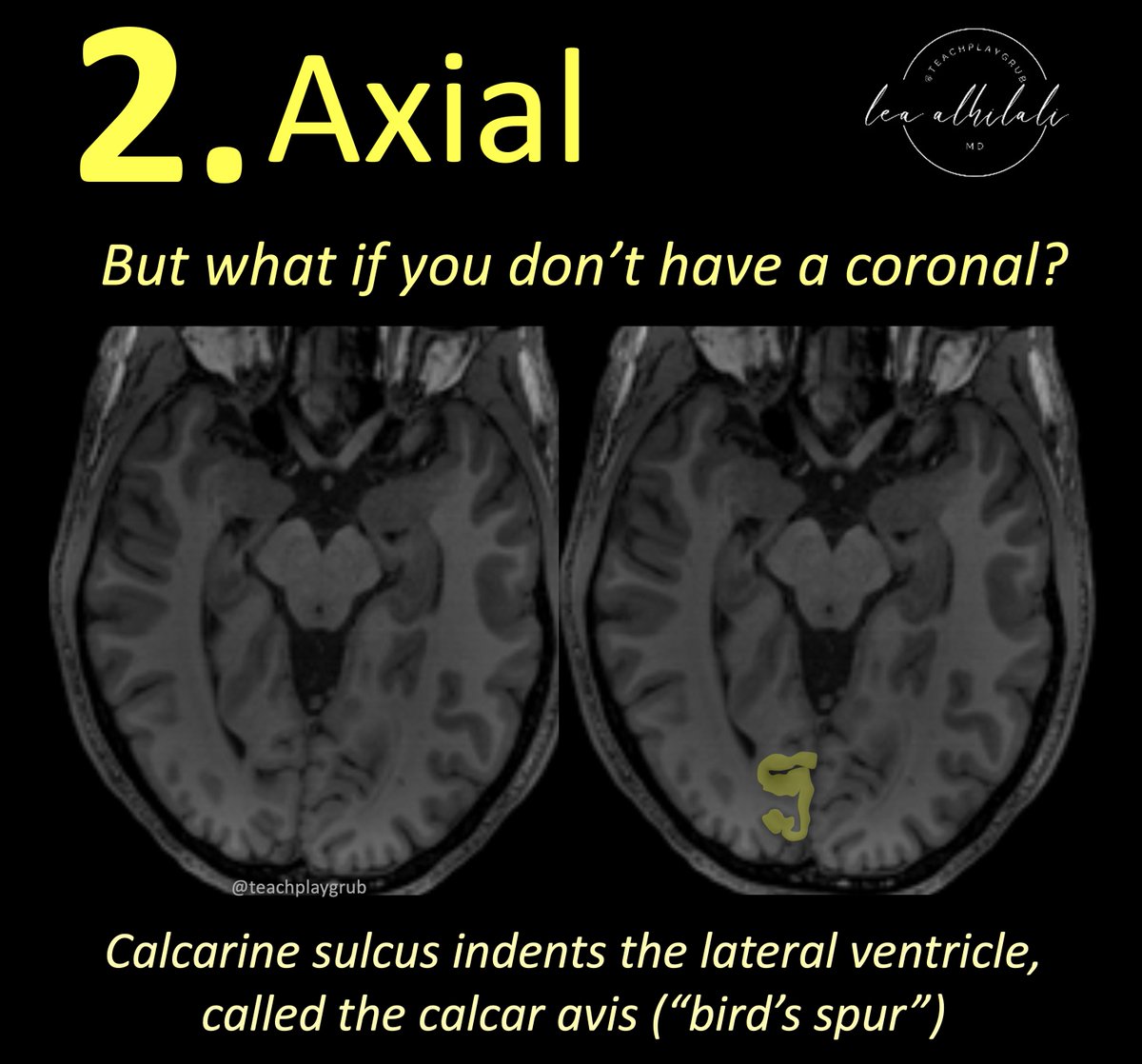 Having trouble visualizing the location of the visual cortex? Wish you ...