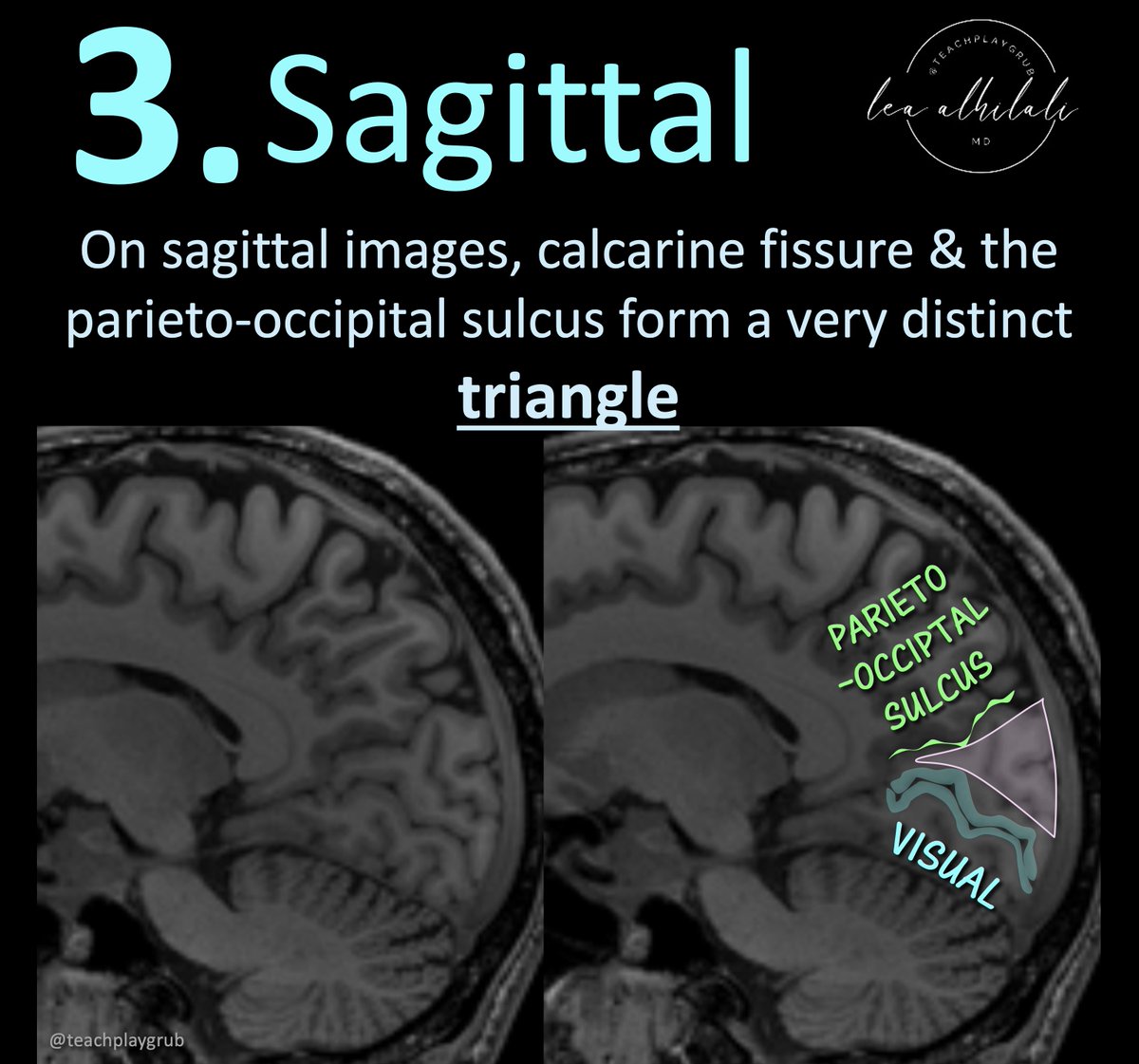 Having trouble visualizing the location of the visual cortex? Wish you ...