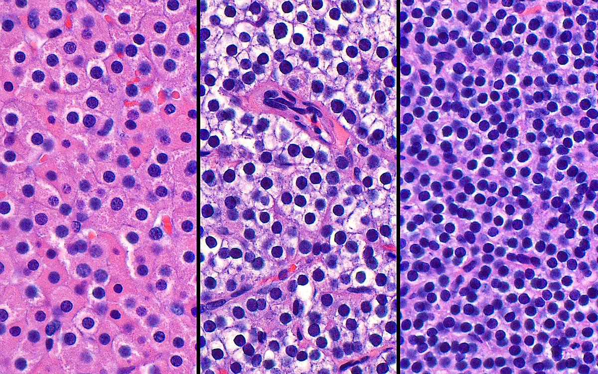 Parathyroid Histology Chief Cells Parathyroid Gland Oxyphil And Chief