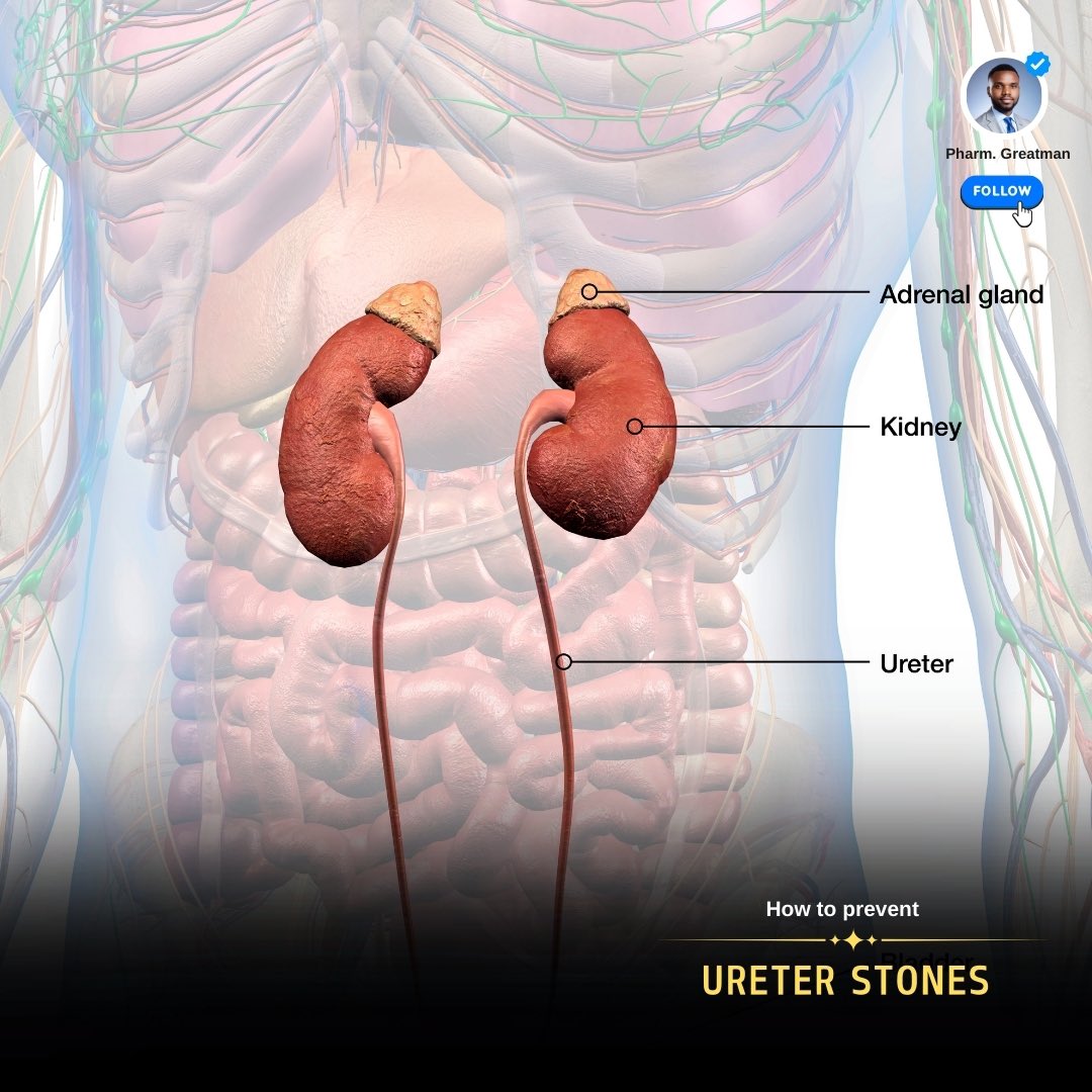 URETER STONES This is felt like a sharp pain in your back or trouble ...