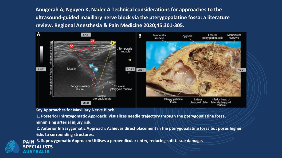 Maxillary Nerve Block JaypeeDigital | EBook Reader