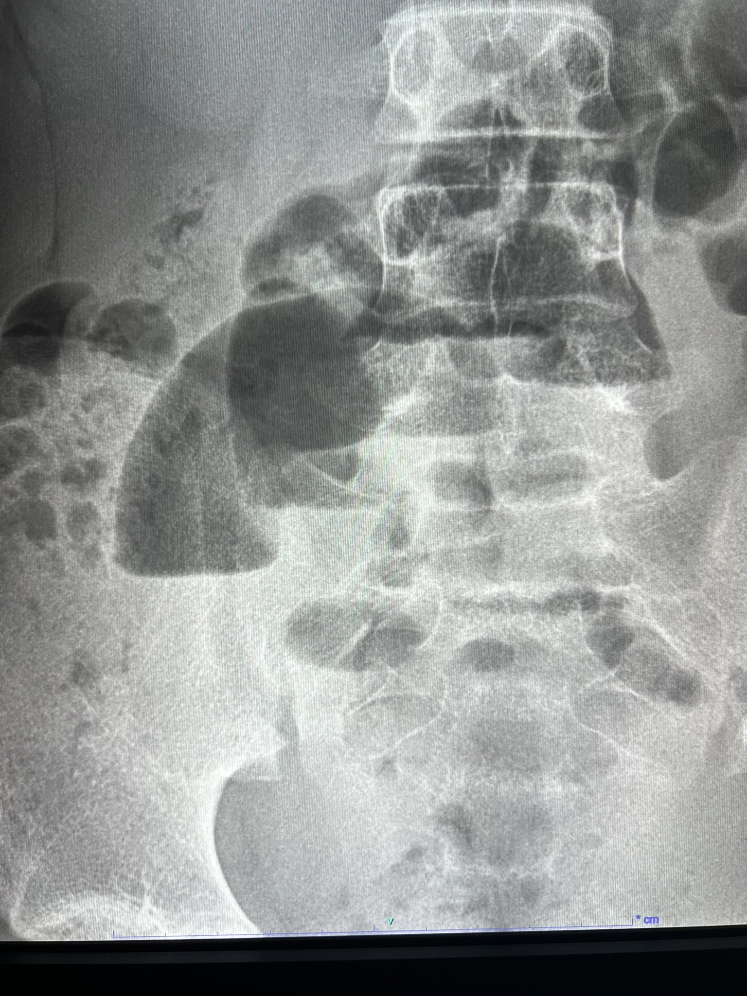 Small Bowel Obstruction Air Fluid Levels