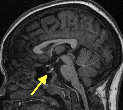 Imaging findings of idiopathic intracranial hypertension (pseudotumor ...