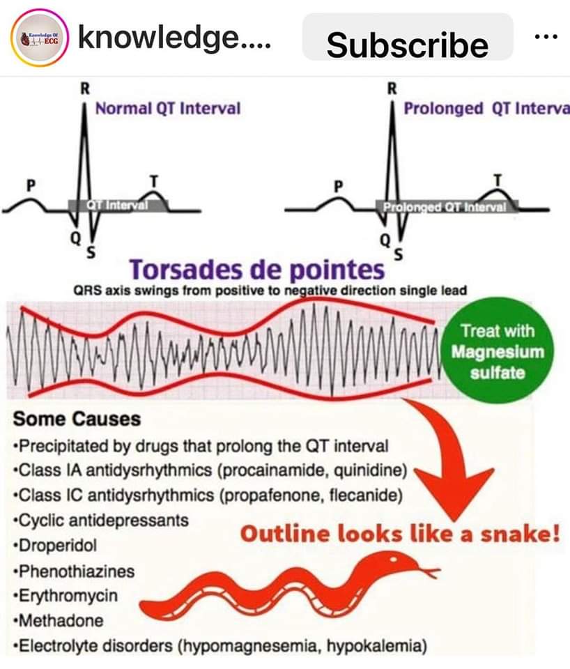🔴Torsades de pointes (TdP) is a specific form of PVT occurring in the ...