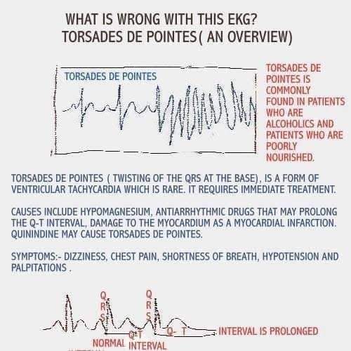 🔴Torsades de pointes (TdP) is a specific form of PVT occurring in the ...