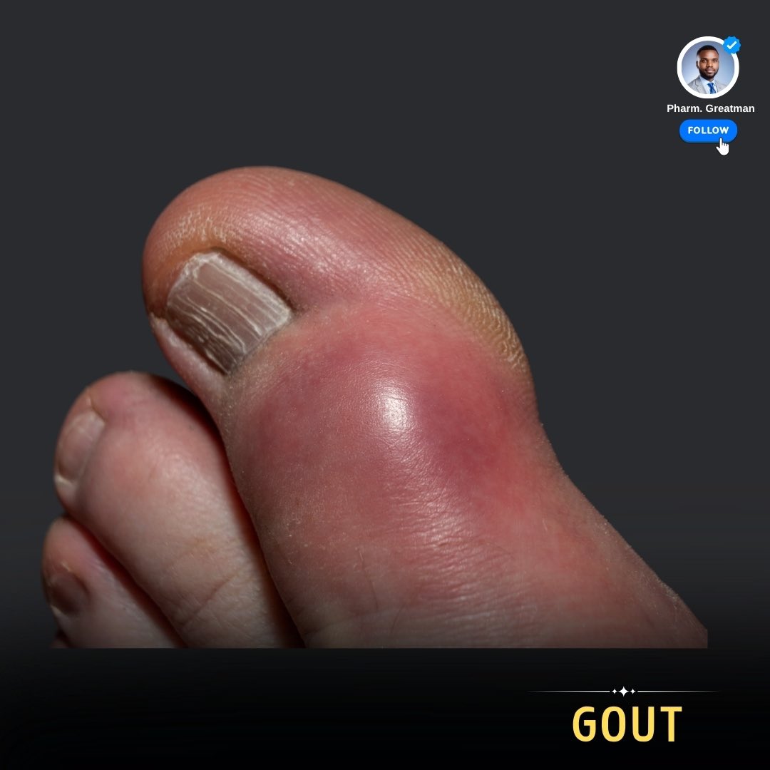 Gout can affect your big toe, ankles, knees, wrists, and more! Learn ...