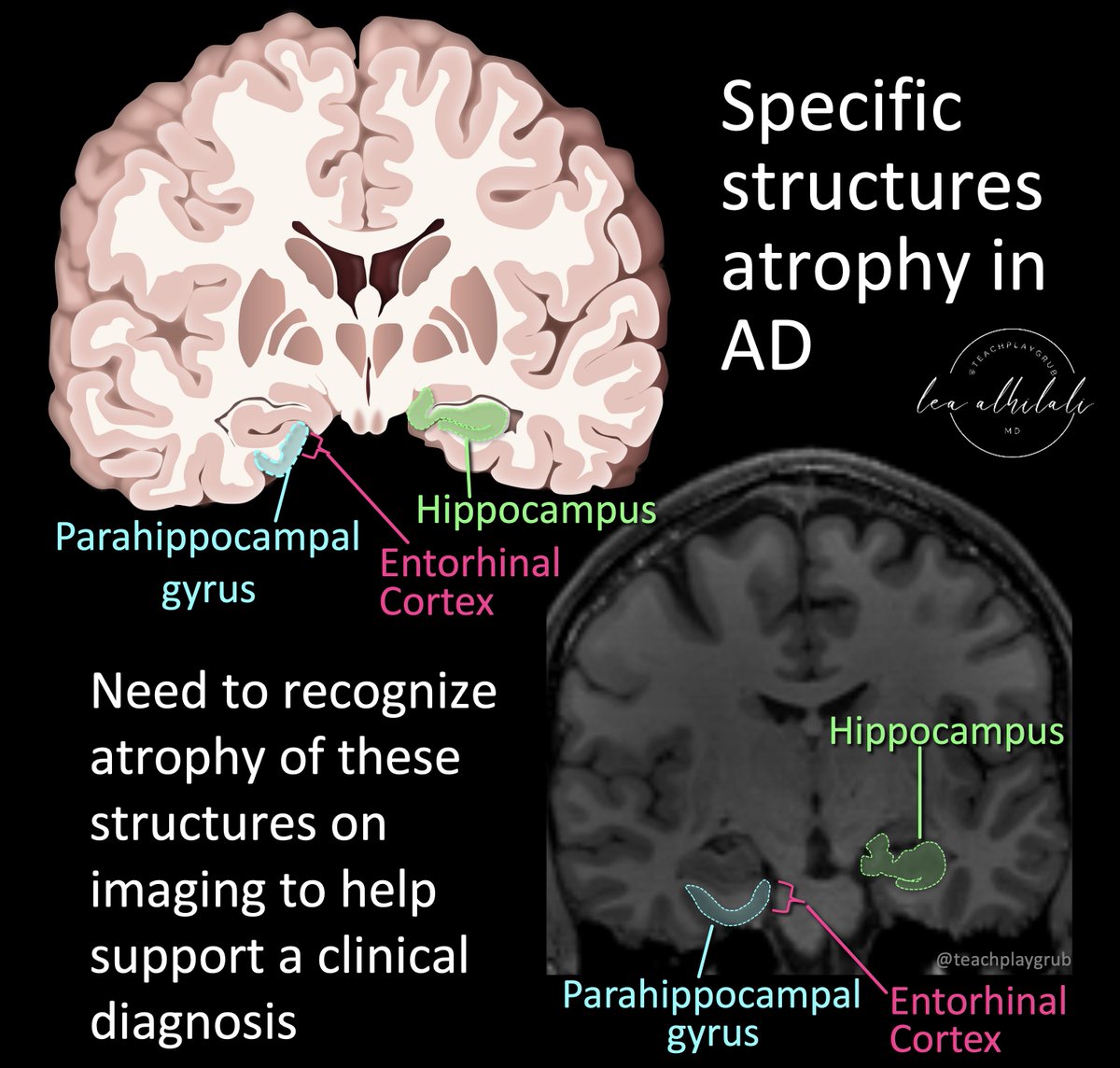 1/Having trouble remembering what to look for on scans for Alzheimer’s ...