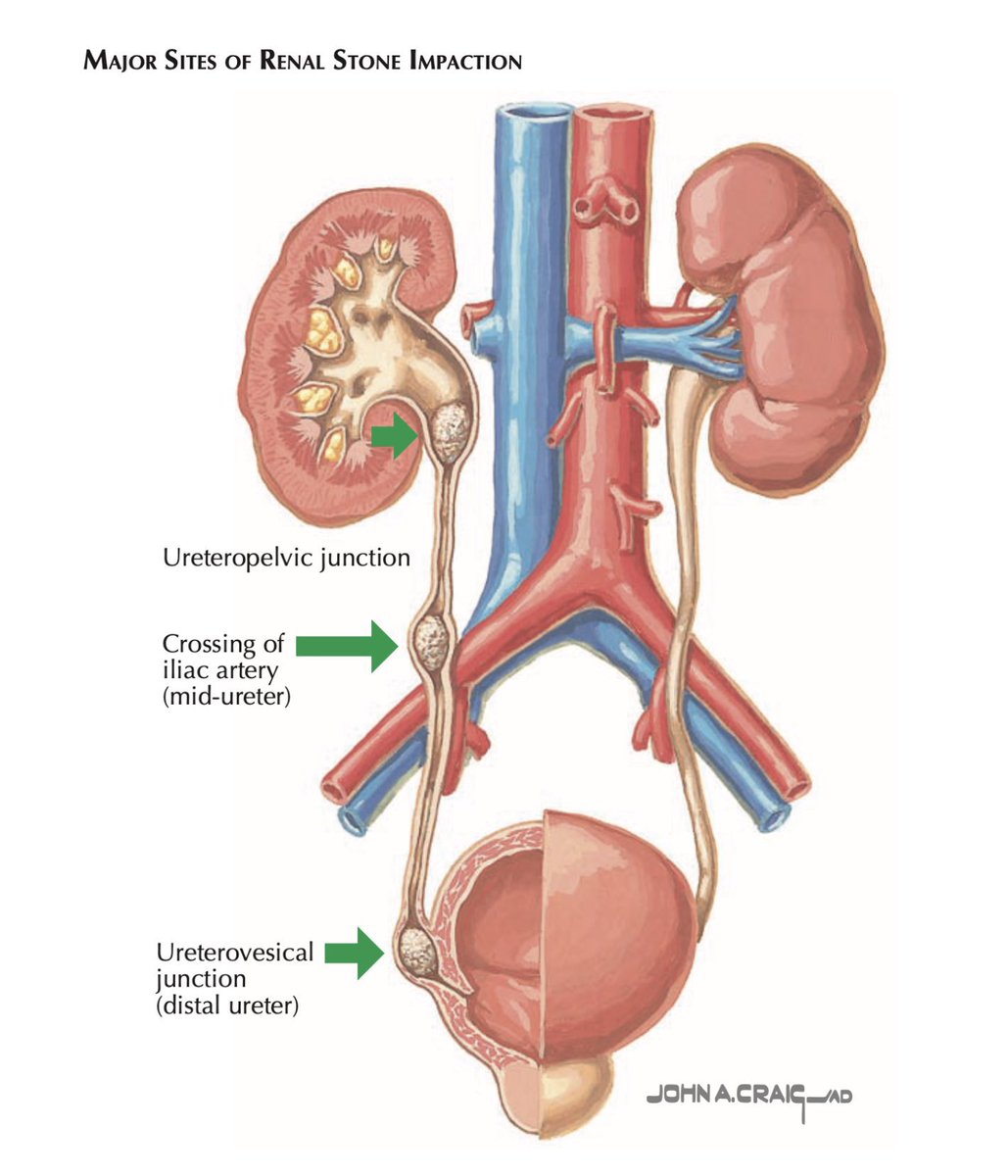 Ureterovesical Junction Kidney Stone UPJ Obstruction Information