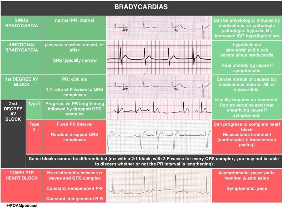 Second Degree Heart Block Ekg