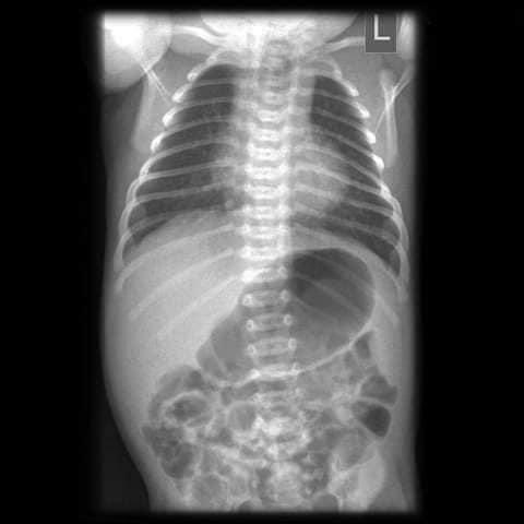 #SHAPES_OF_THE_HEART_IN_CXR_IN: الأشكال المختلفة للقلب في صور الأشعة ...