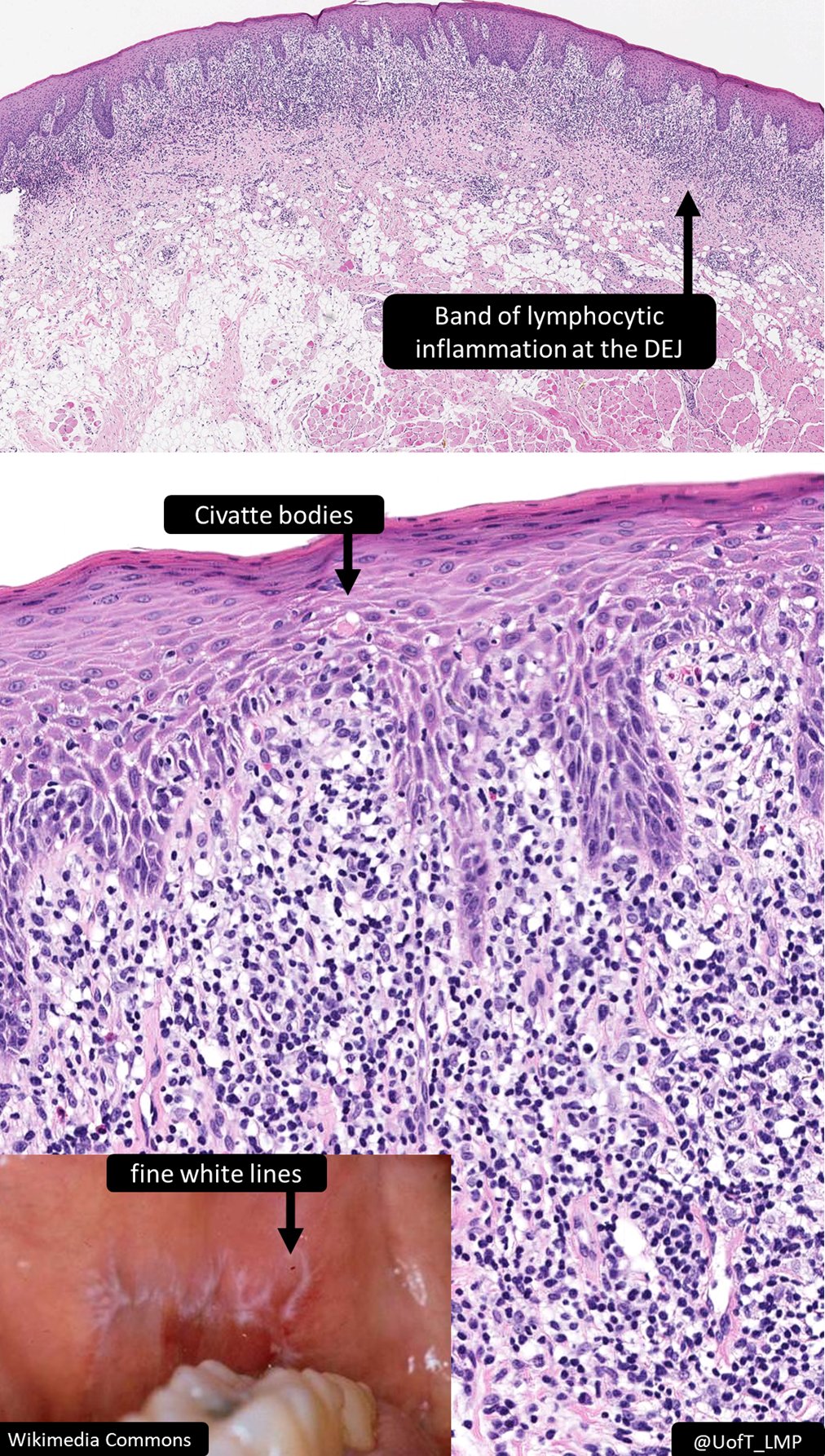 Lichen Planus Histology Civatte Body Jcdr 7 312 G001.jpg
