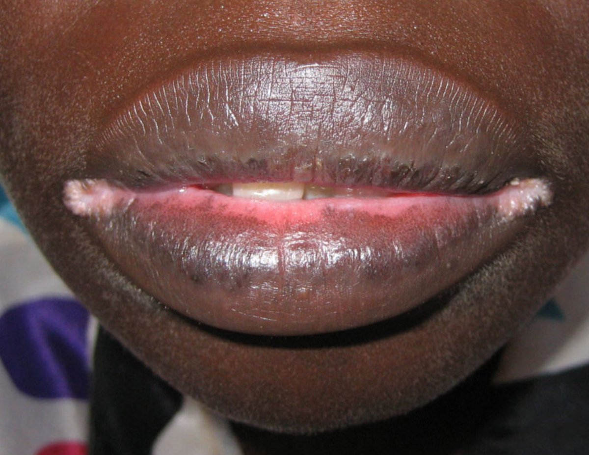 Discolouration of the lips with no common cause like alcoholism/smoking ...