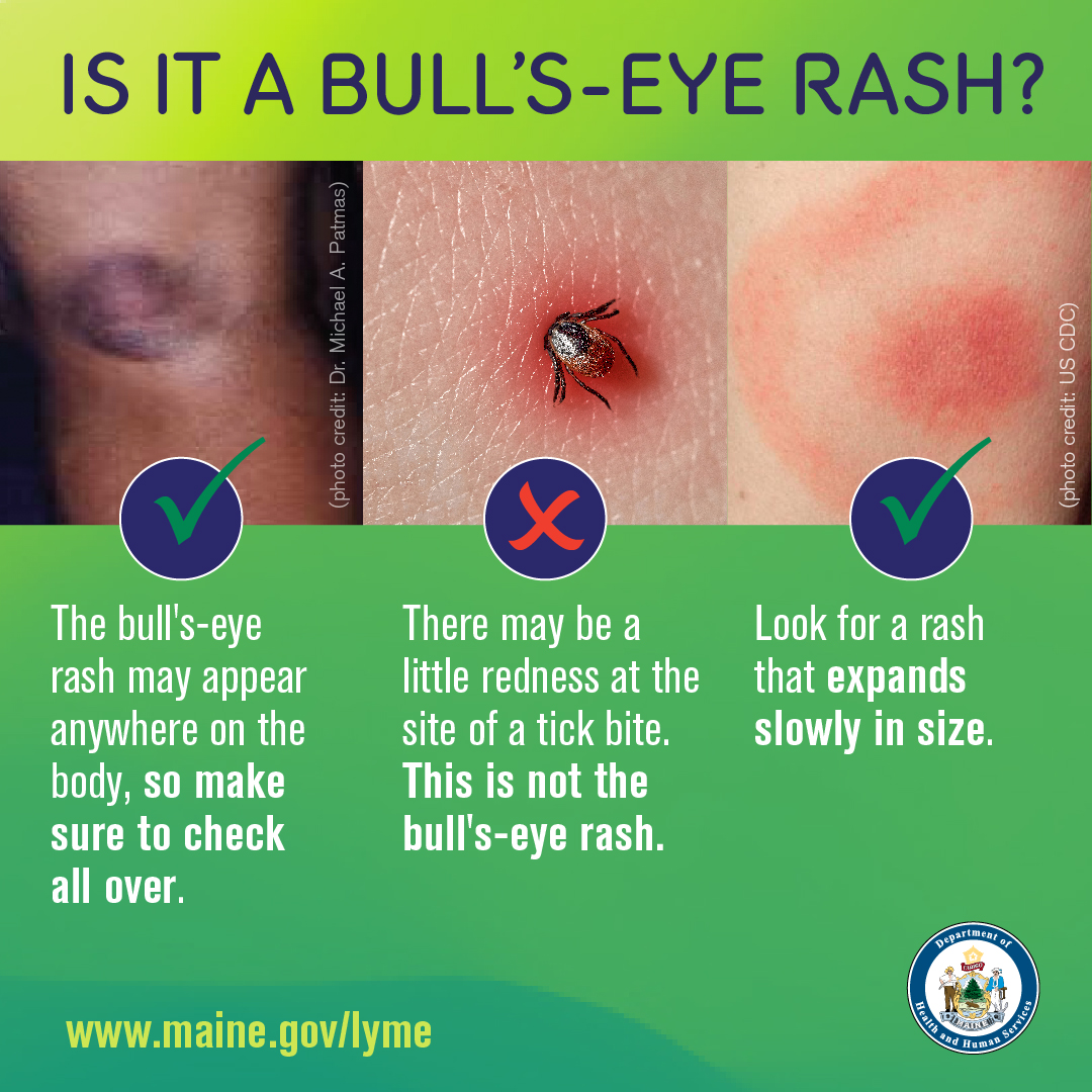 Images Of Tick Bite Rashes
