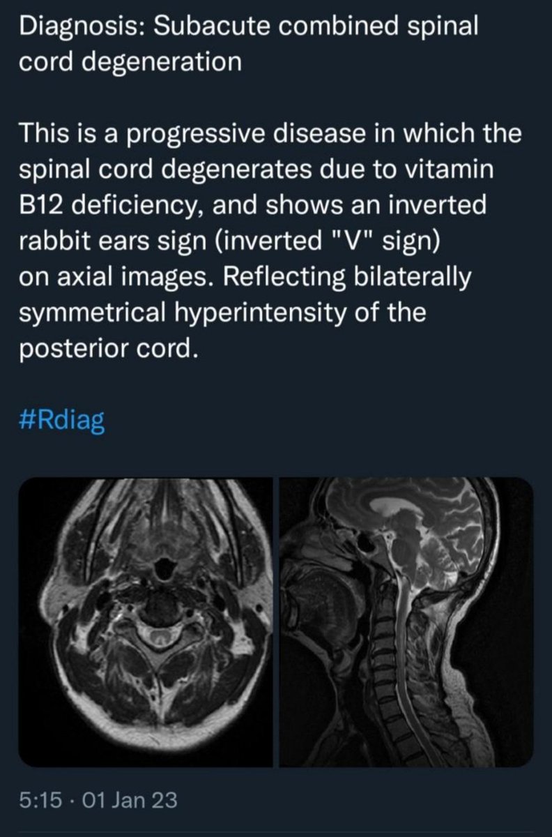 Vitamin B12 Deficiency Spinal Cord