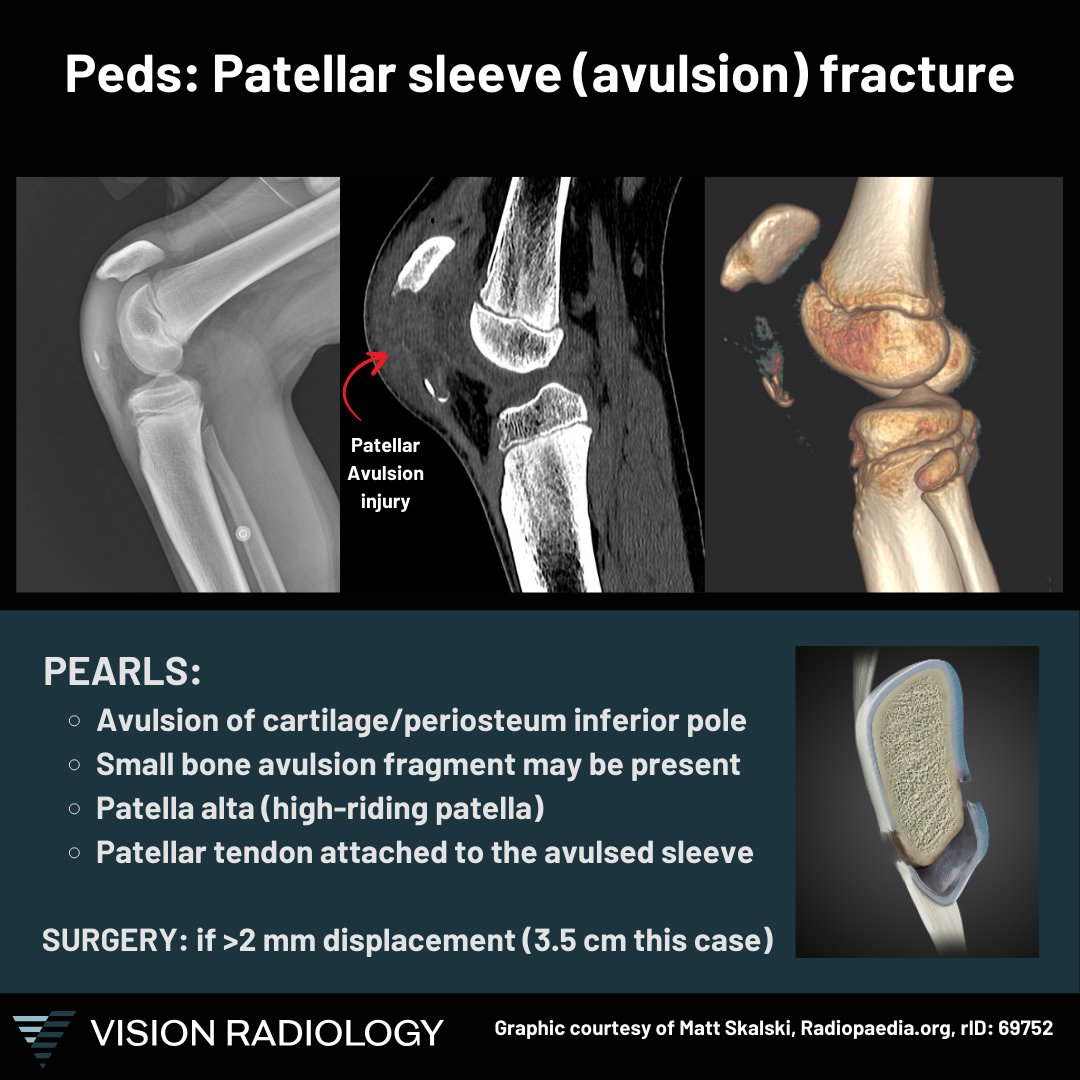 Quadriceps Tendon Rupture Image Radiopaediaorg Quadriceps Tendon