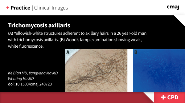 Trichomycosis Axillaris