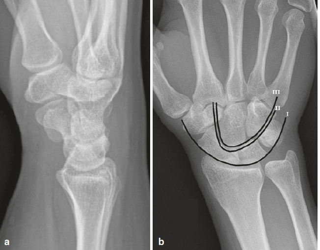 Normal Wrist Radiograph Radiographs Of Upper Extremity: Fractures And