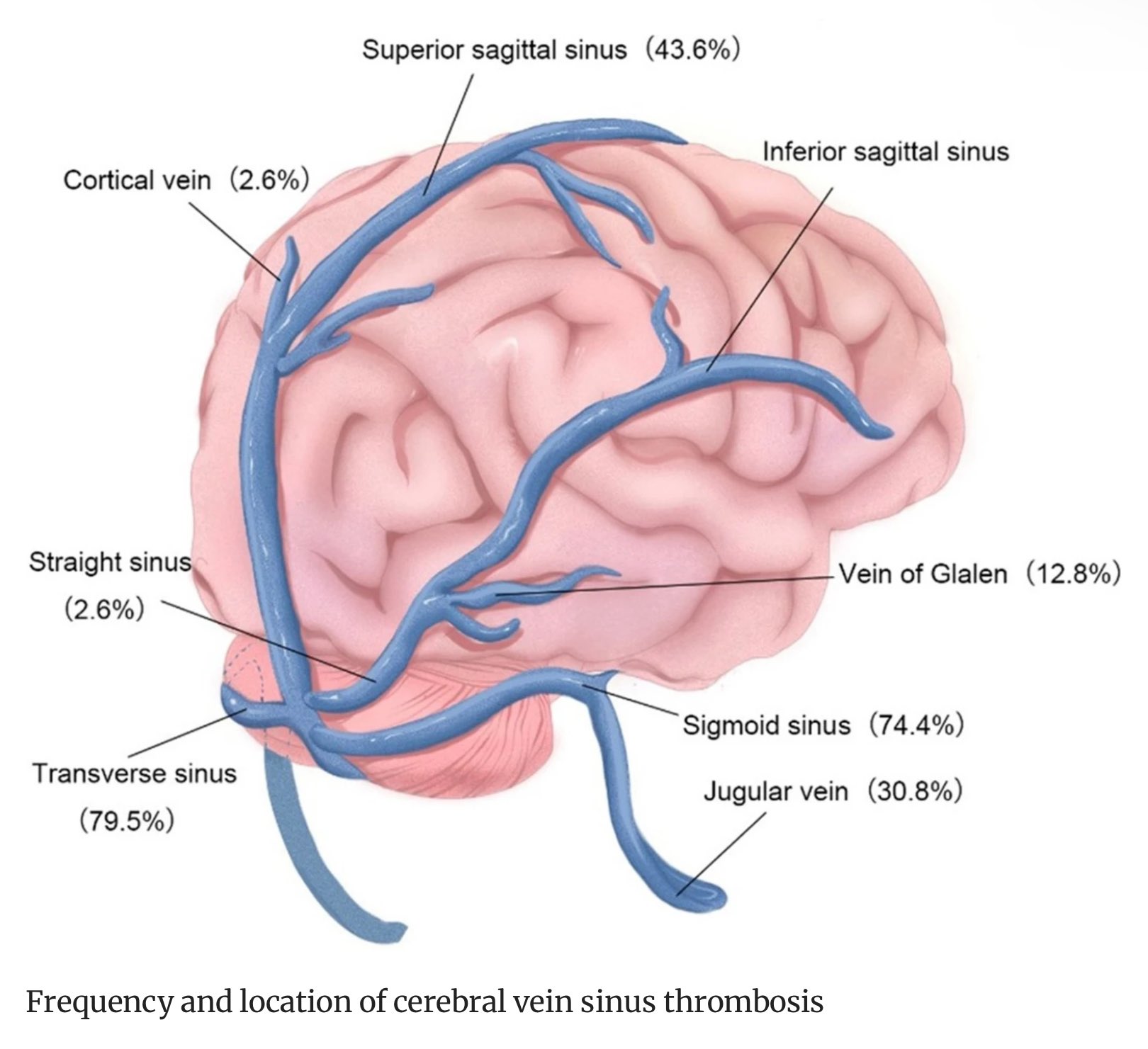 Sigmoid Sinus