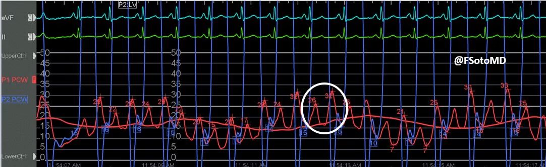 “The wedge.” The holy grail of RHC and hemodynamics Hate it or love it ...