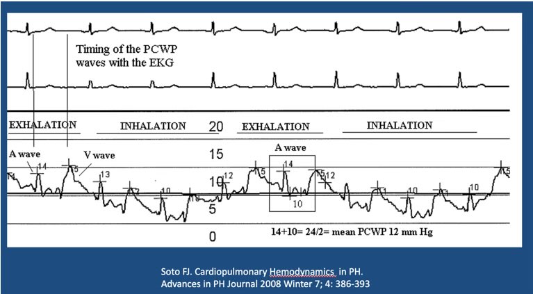 “The wedge.” The holy grail of RHC and hemodynamics Hate it or love it ...
