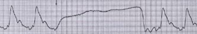 “The wedge.” The holy grail of RHC and hemodynamics Hate it or love it ...