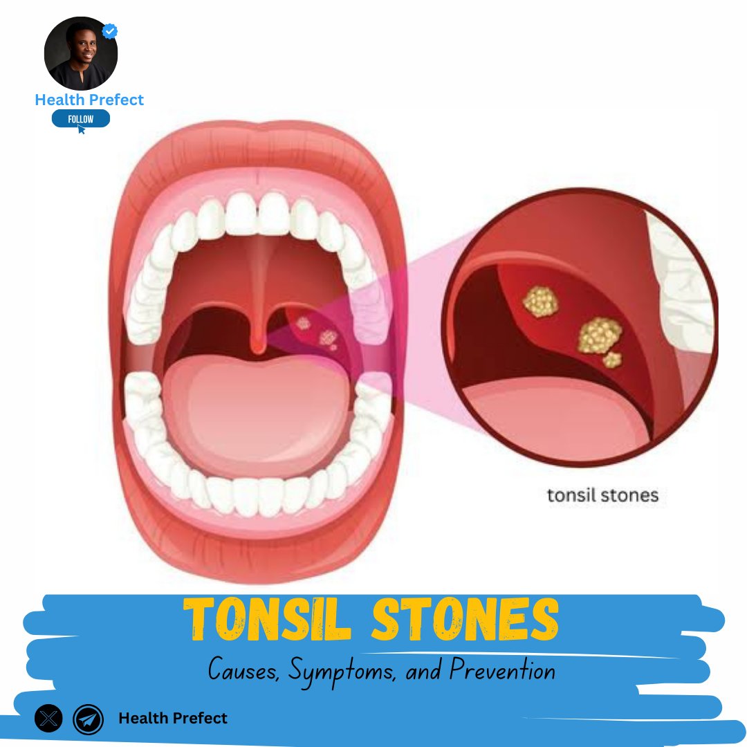 Tonsil stones, or tonsilloliths, are small, calcified formations that ...