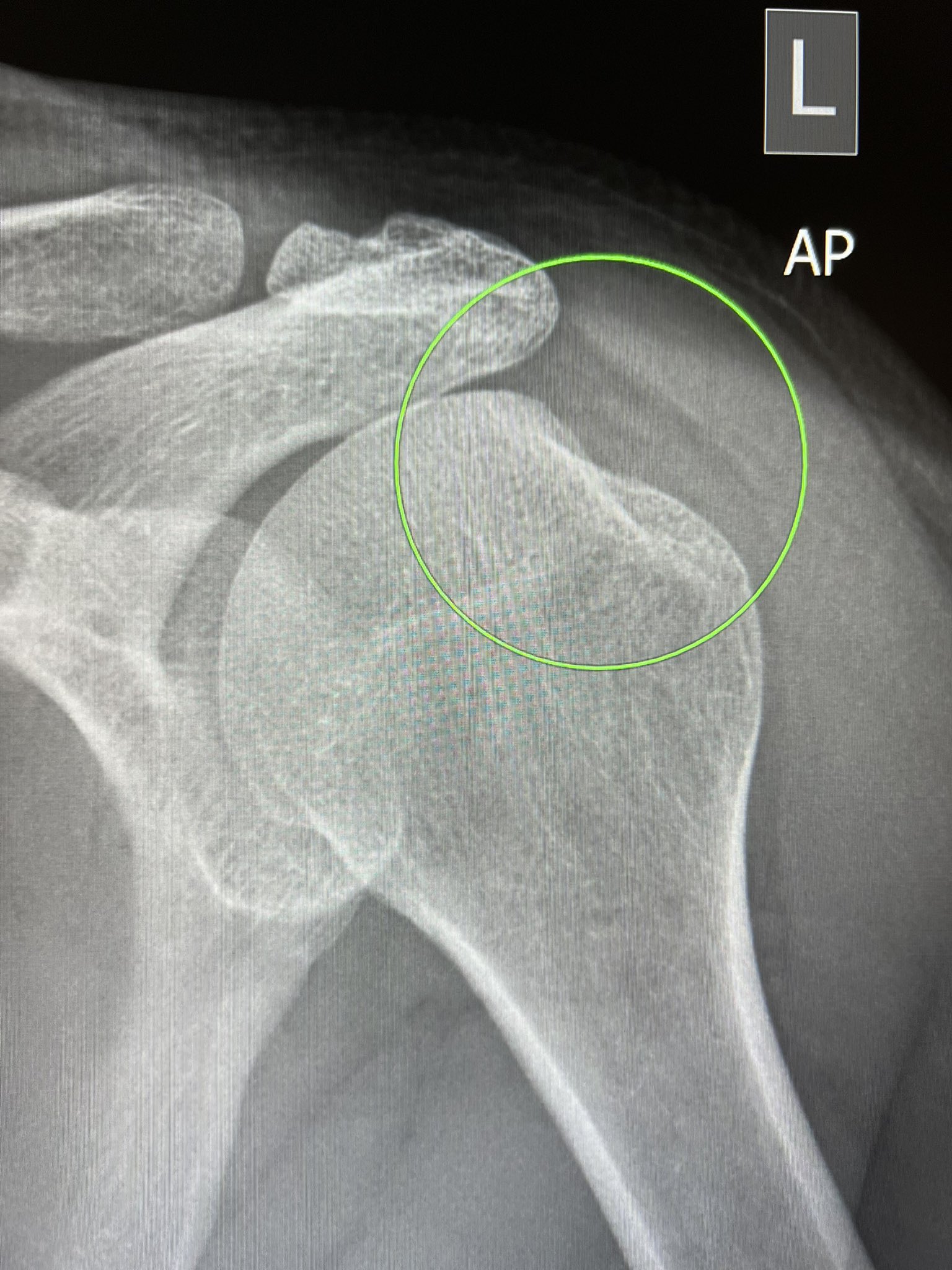 X Ray Shoulder Internal Rotation