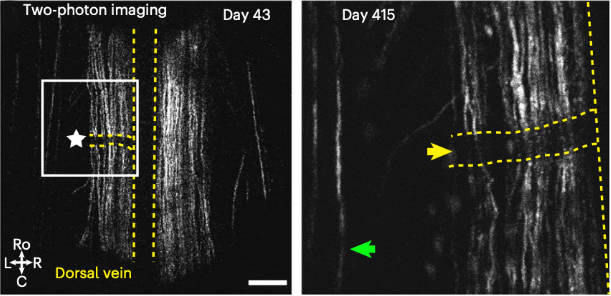 Spinal Fibrosis