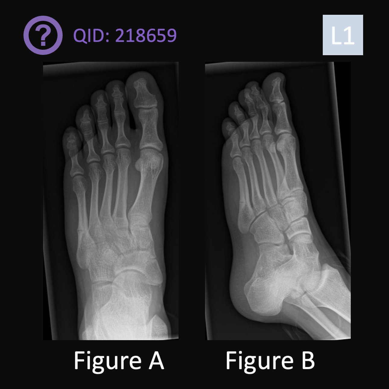 Jones Fracture Orthobullets
