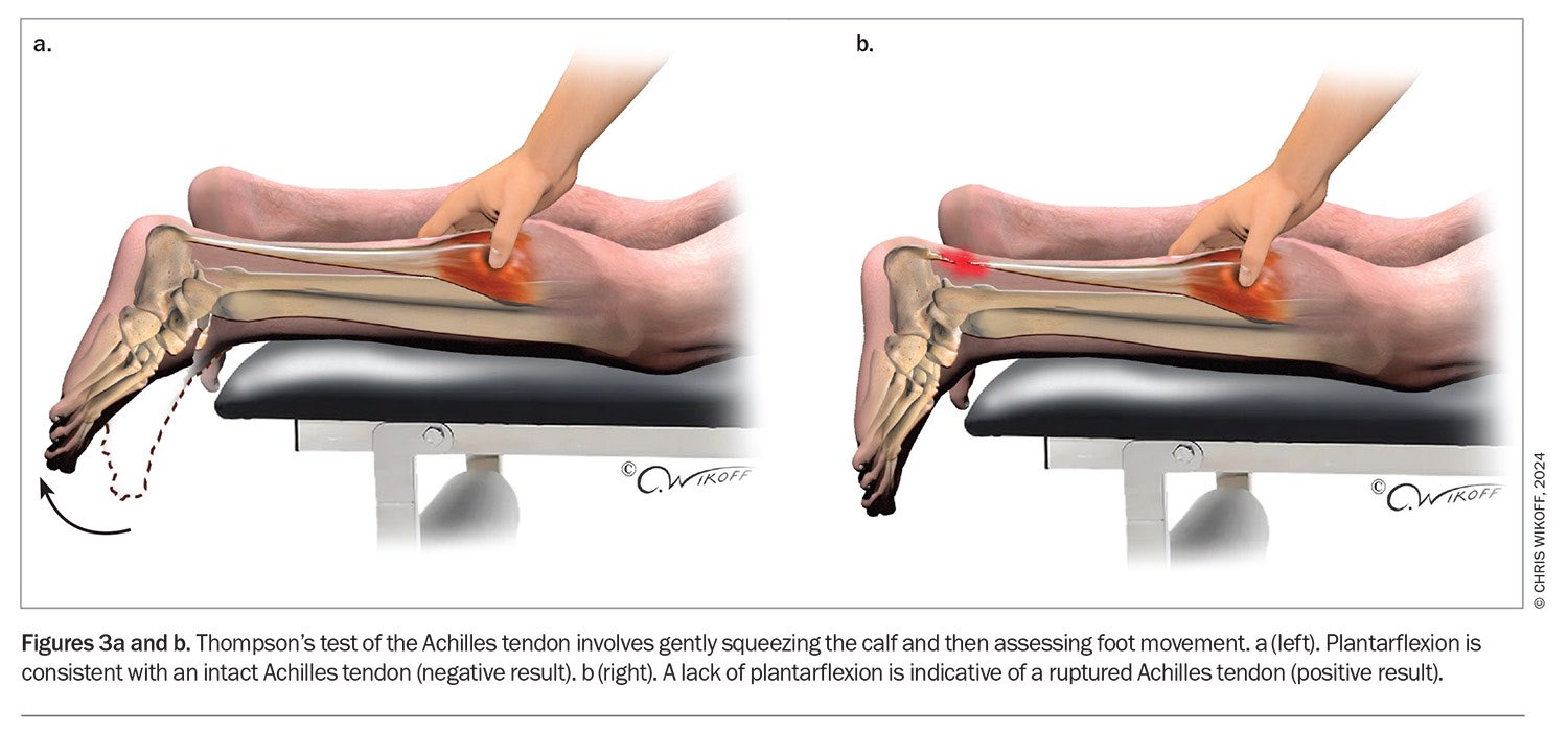 Thompson Test Achilles Rupture Physical Therapy In St. Albans For