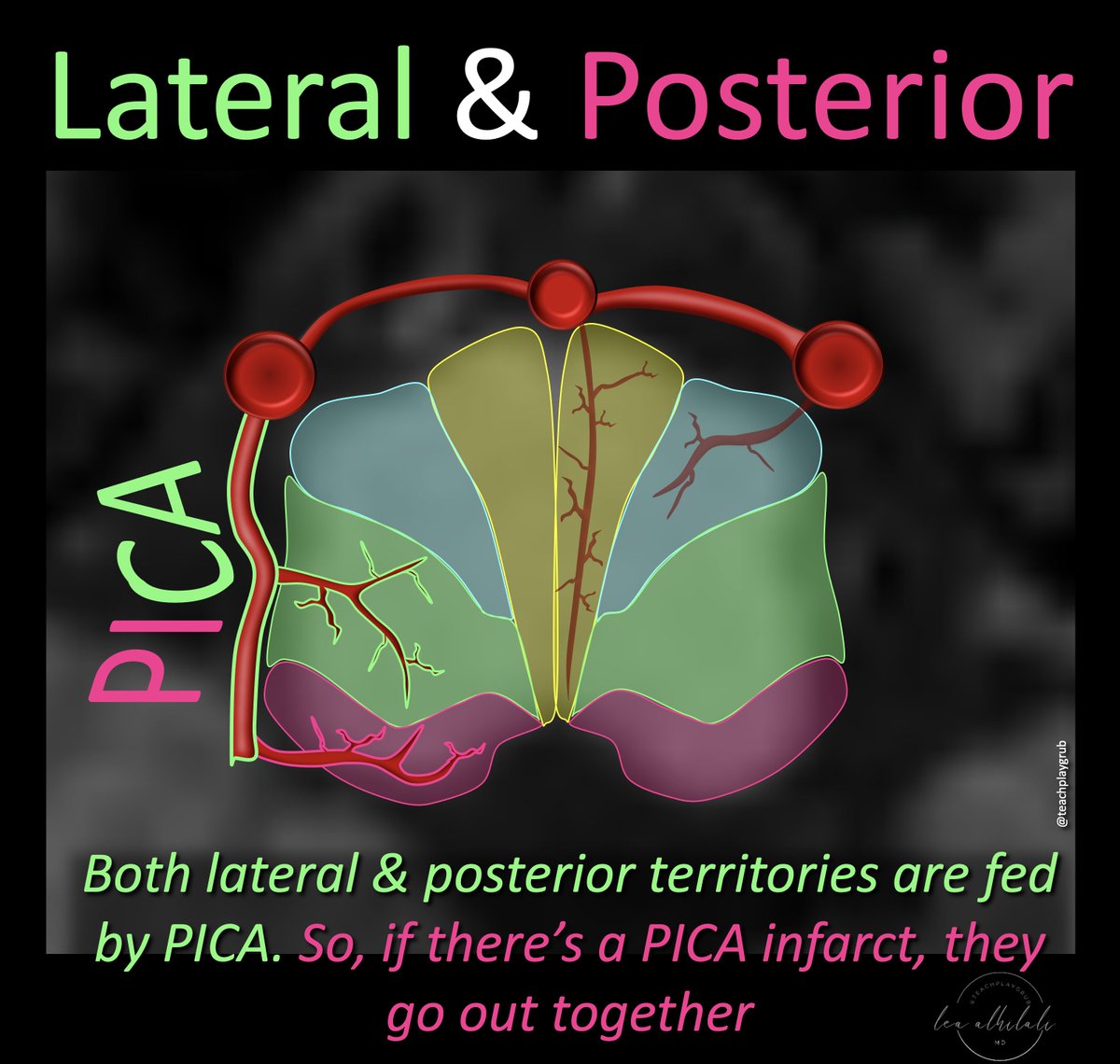 1/The medulla is anything but DULL! Does seeing an infarct in the ...