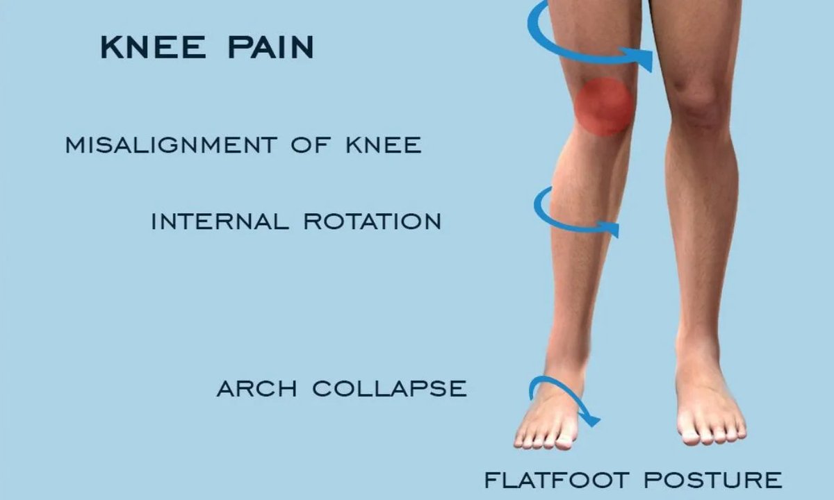 Weak feet silently wrecking your posture and causing pain. Flat arches ...