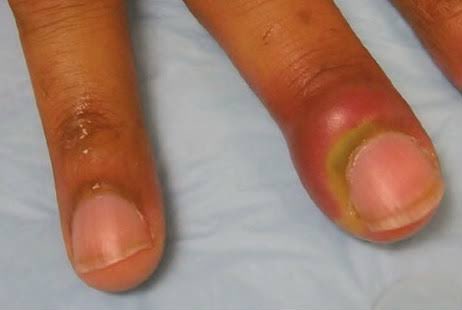 WHITLOW: SPOT THE EARLY SYMPTOMS AND PREVENT IT Whitlow is a painful ...